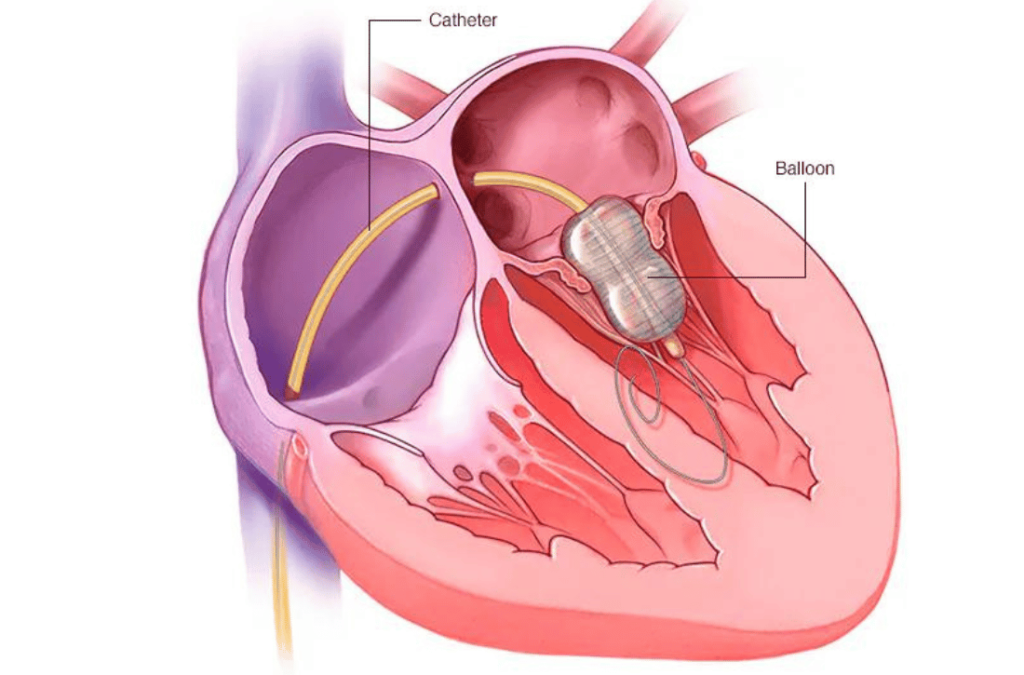Balloon Mitral Valvotomy - Dr Ankeet Dhedhia