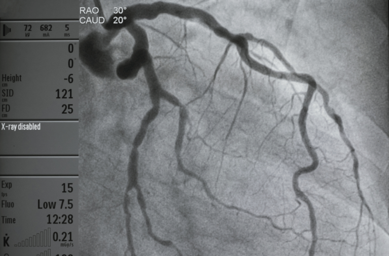 Coronary Angiography - Dr Ankeet Dhedhia