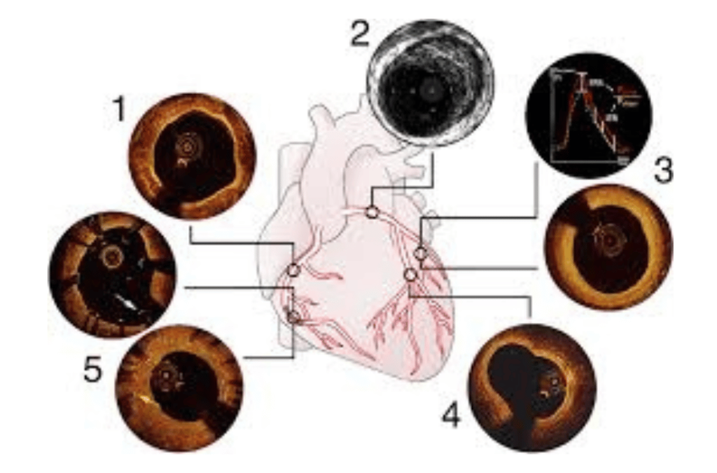 Intracoronary Imaging Dr Ankeet Dhedhia