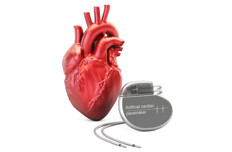 Pacemaker Implantation - Dr Ankeet Dhedhia